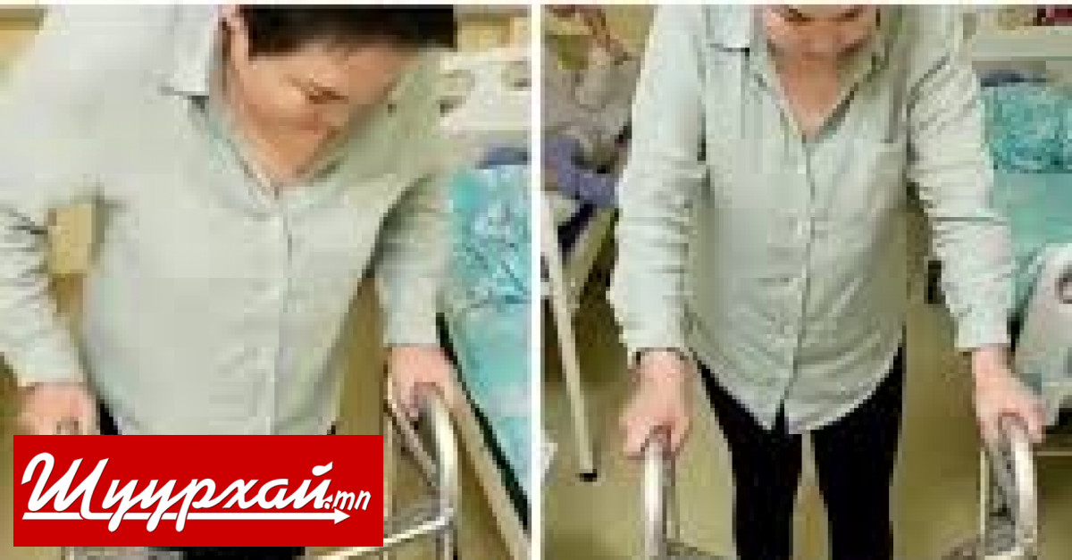 ЭМЯ Вакцин хийлгээд хөл мэдээгүй болсон гэх эмэгтэйн өвчний шалтгааныг эмч нар судалж байна